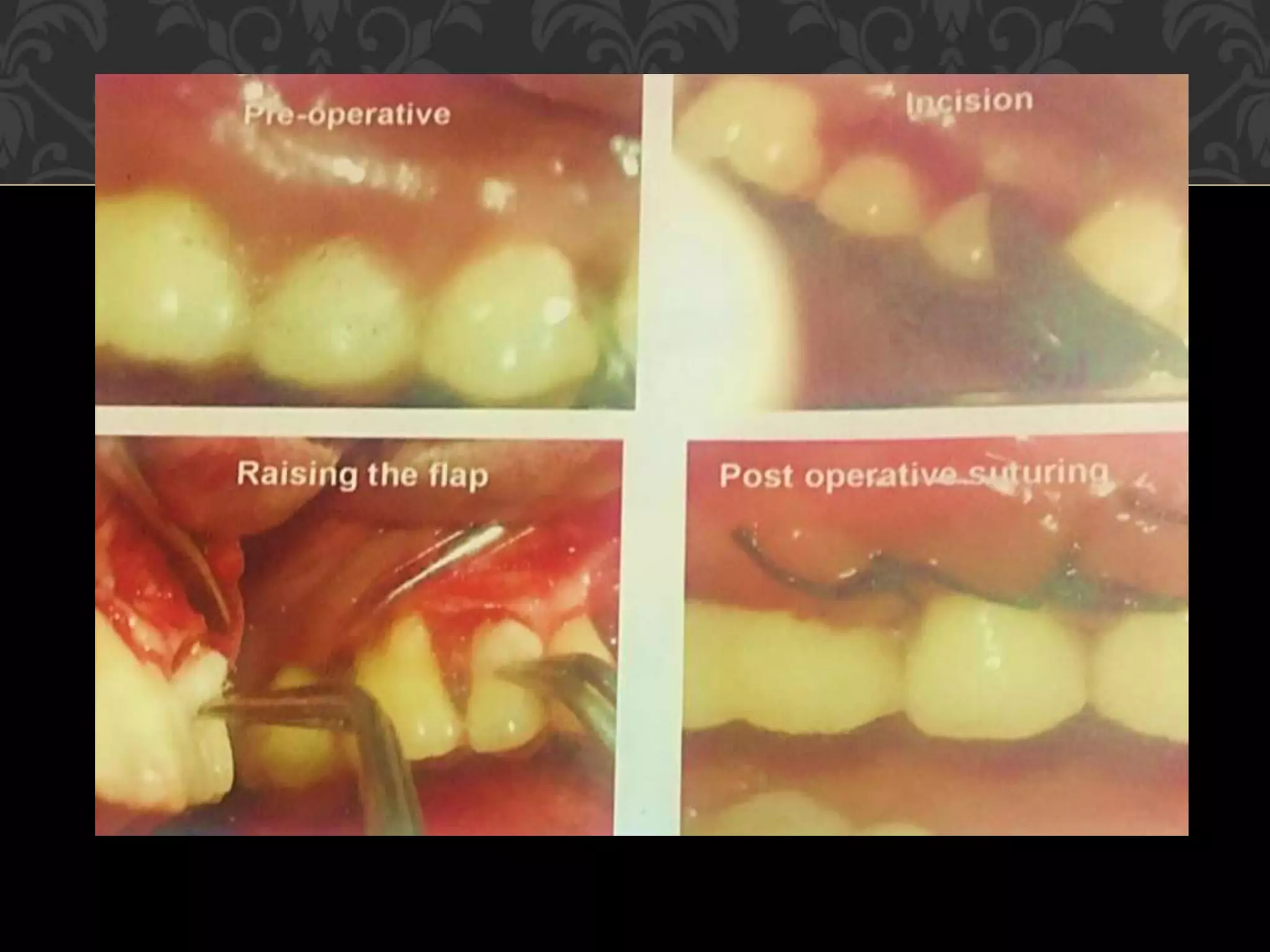 minor oral surgical procedures in pediatric dentistry | PPTX