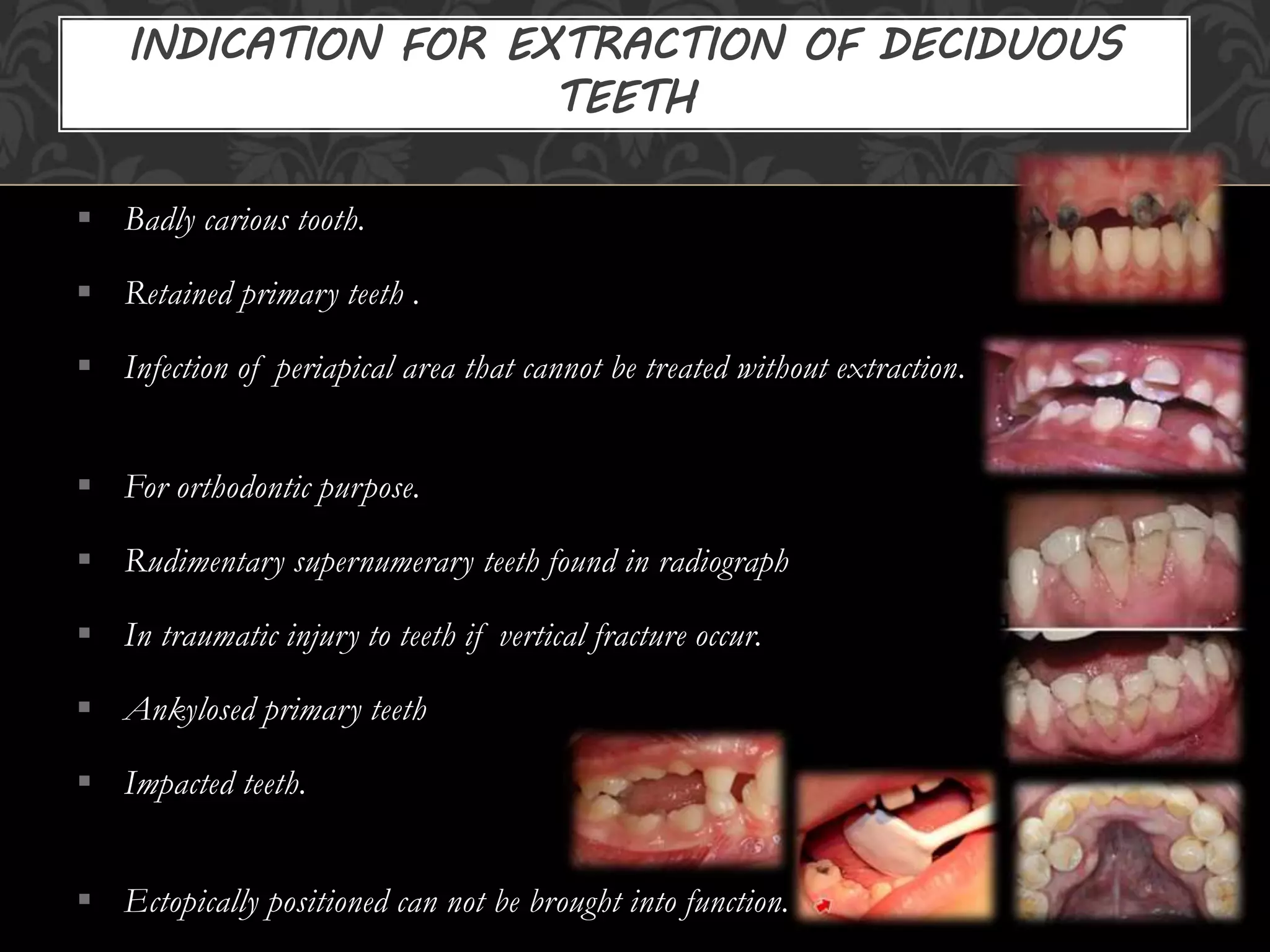 minor oral surgical procedures in pediatric dentistry | PPTX