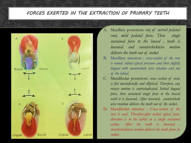 minor oral surgical procedures in pediatric dentistry | PPTX | Dental ...