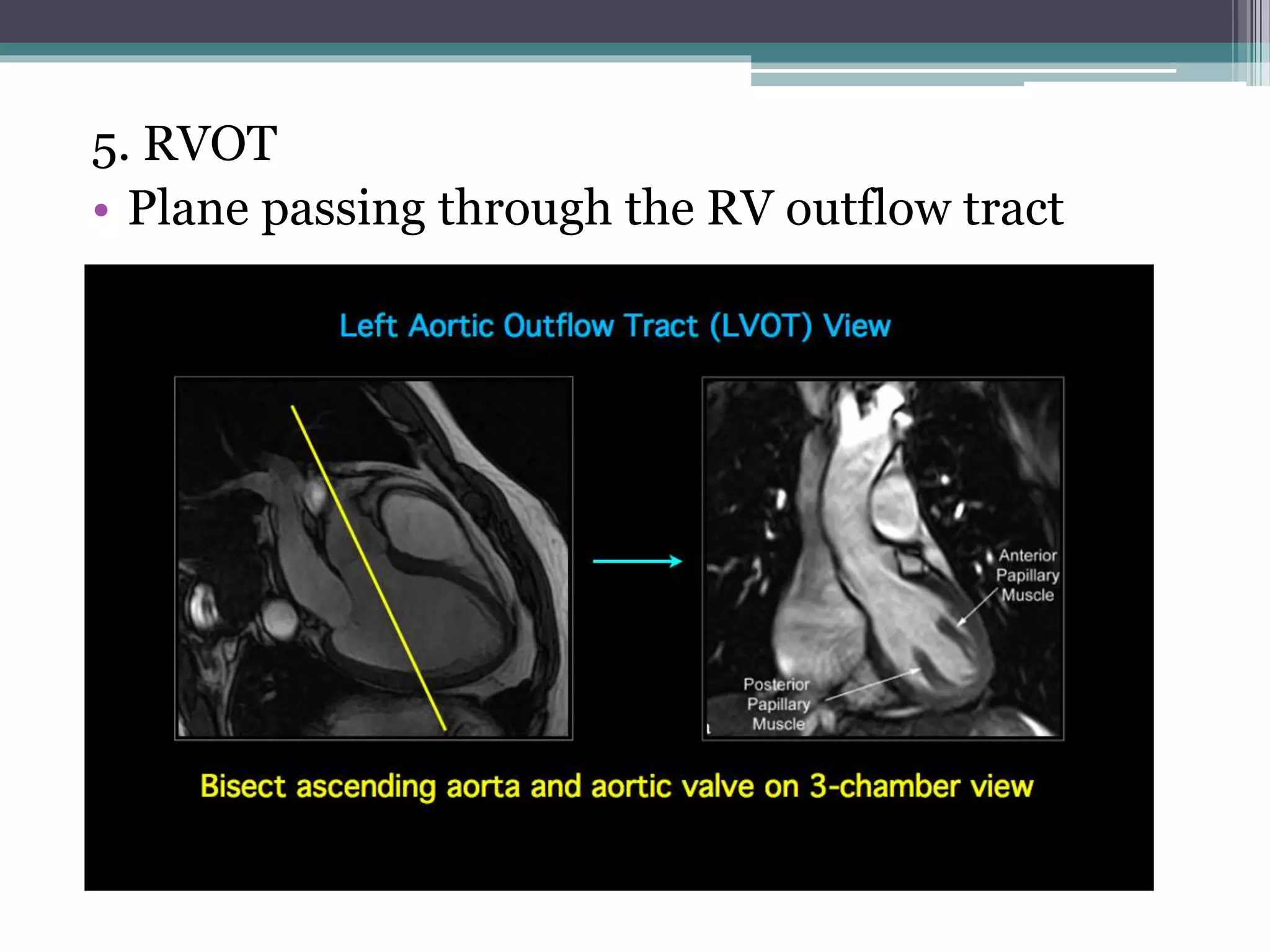 Cardiac Magnetic Resonance Imaging | PPTX