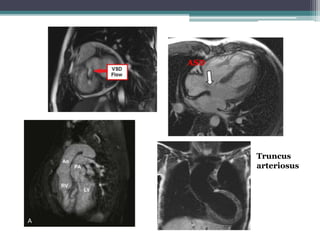 Cardiac Magnetic Resonance Imaging | PPTX