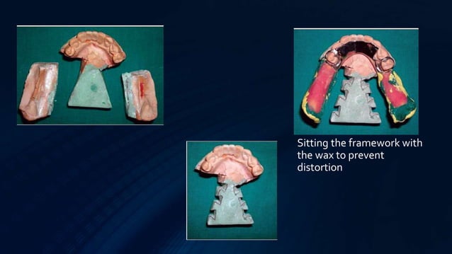 impression in RPD | PPTX | Dental Health | Diseases and Conditions