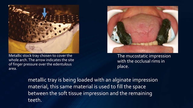 impression in RPD | PPTX | Dental Health | Diseases and Conditions