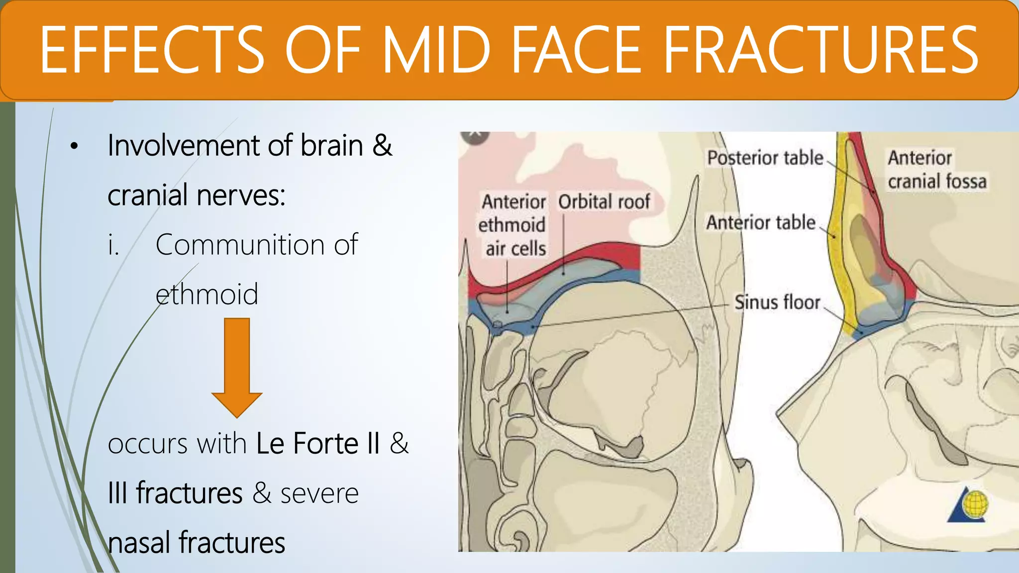 7. fractures of middle third of facial skeleton | PPTX