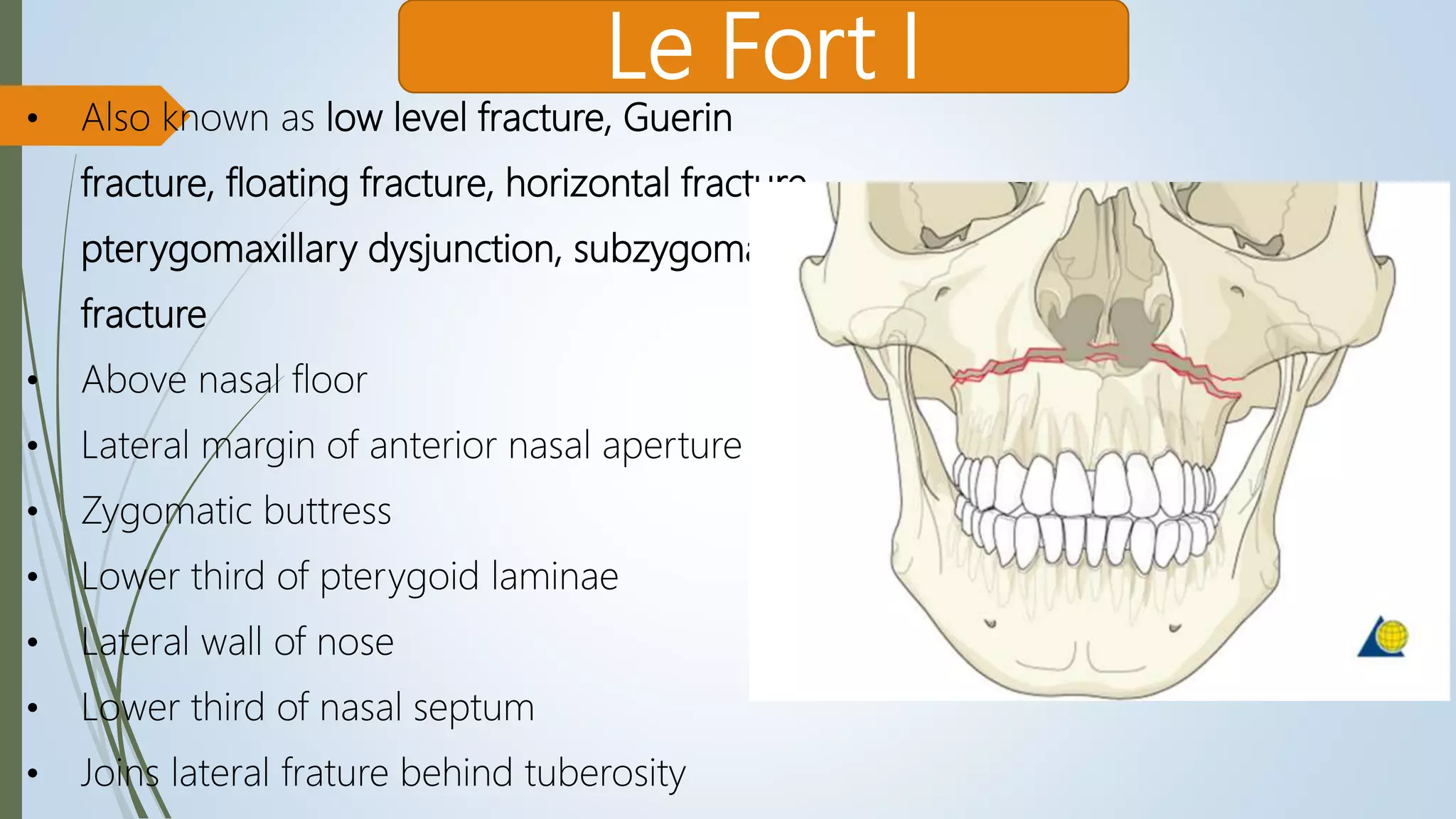 7. fractures of middle third of facial skeleton | PPTX