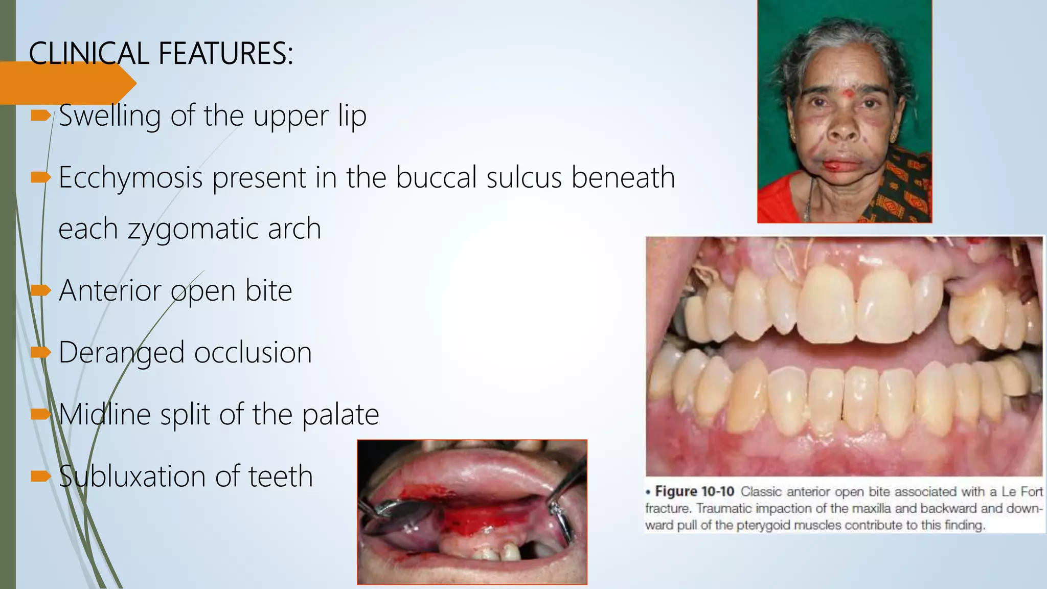 7. fractures of middle third of facial skeleton | PPTX