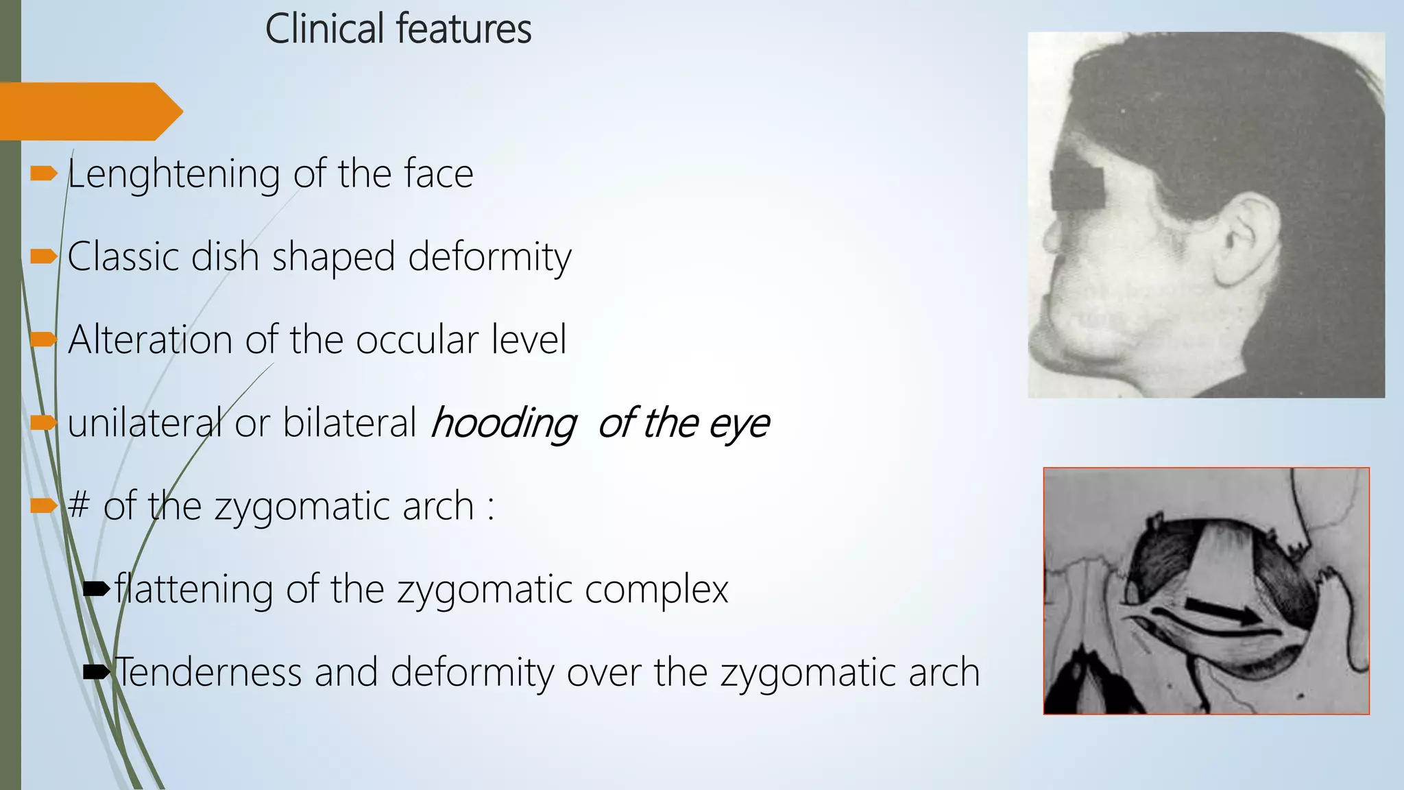 7. fractures of middle third of facial skeleton | PPTX