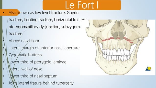 7. fractures of middle third of facial skeleton | PPTX | Death, Injury ...