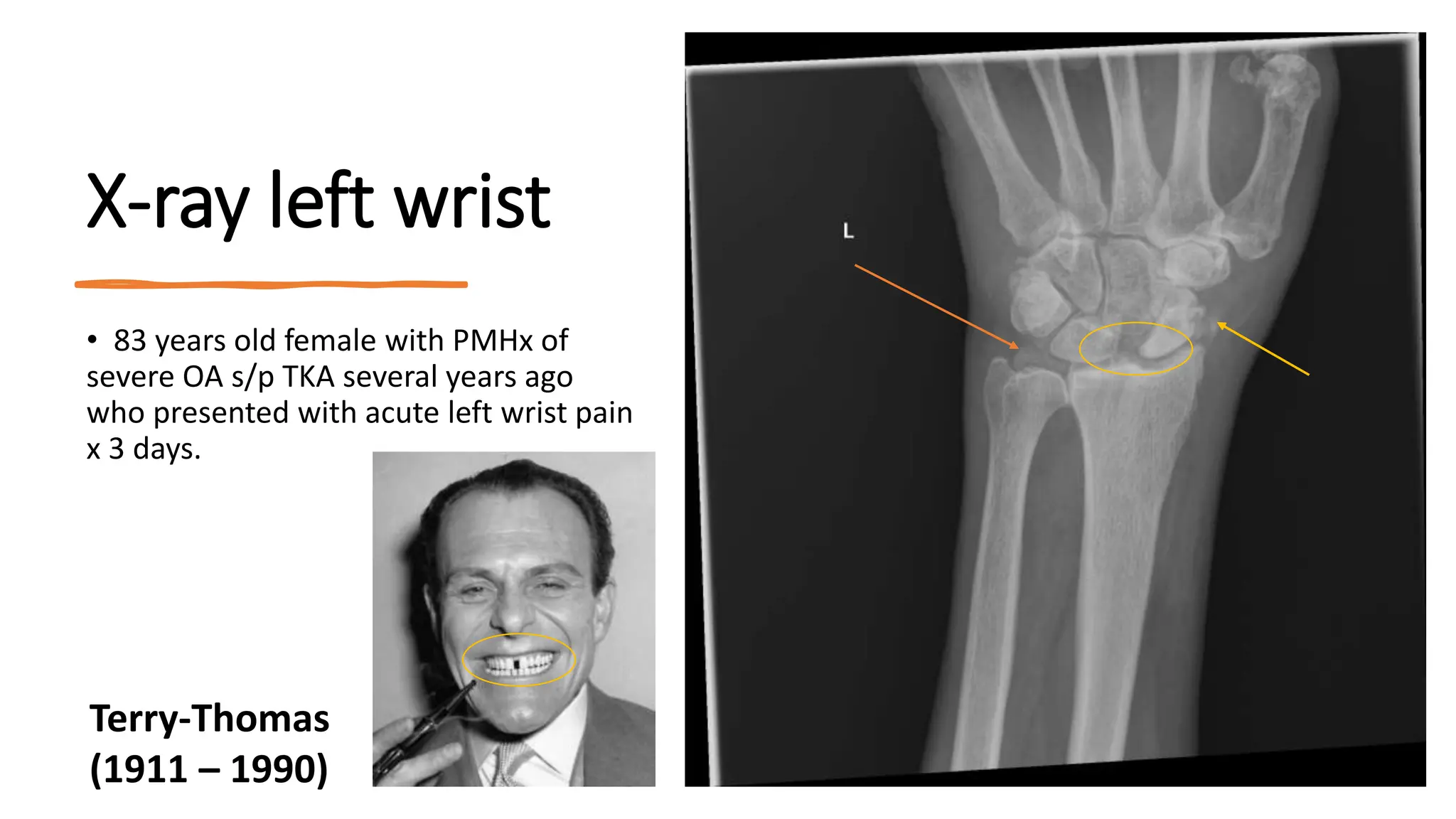Terry Thomas Sign - XRAY Findings and Physical exam | PPT