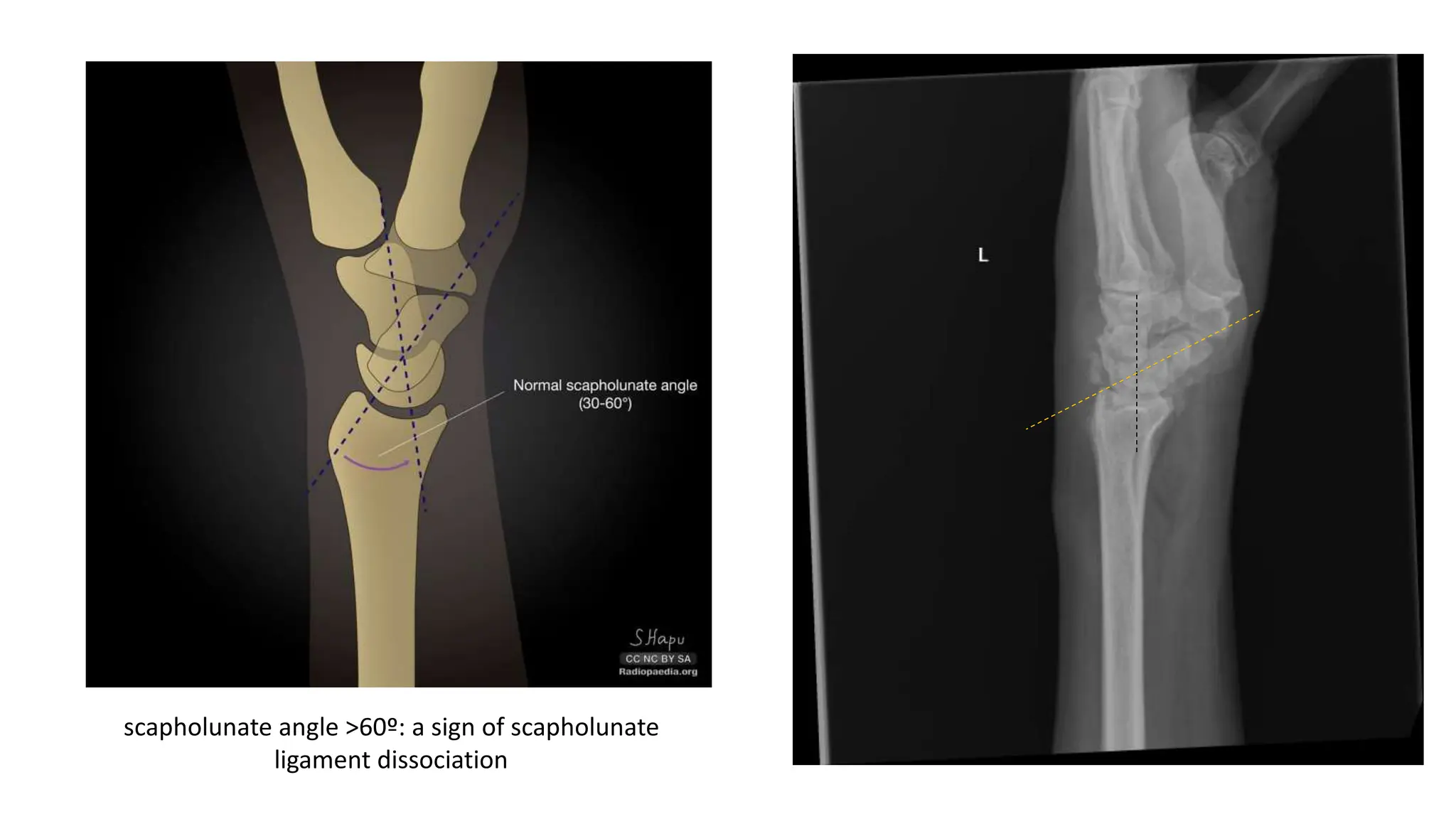 Terry Thomas Sign - XRAY Findings and Physical exam | PPT