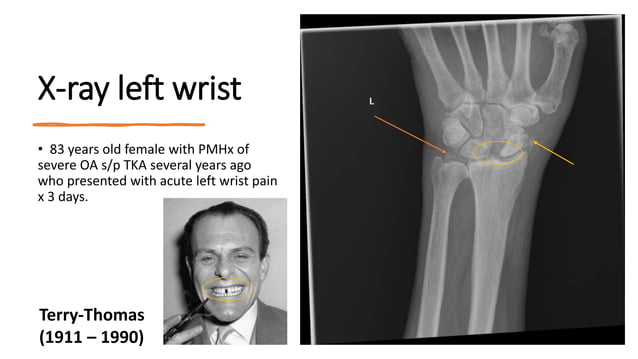 Terry Thomas Sign - XRAY Findings and Physical exam | PPT
