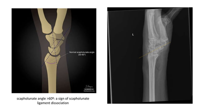 Terry Thomas Sign - XRAY Findings and Physical exam | PPT