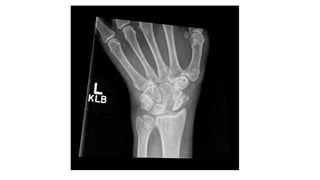 Terry Thomas Sign - XRAY Findings and Physical exam | PPT