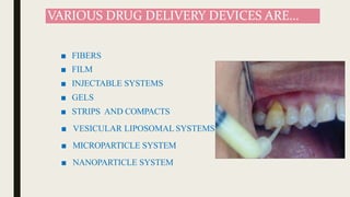 LOCAL DRUG DELIVERY | PPTX