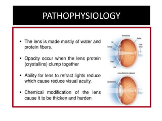 A CASE STUDY ON CATARACT - SLIDESHARE | PPTX