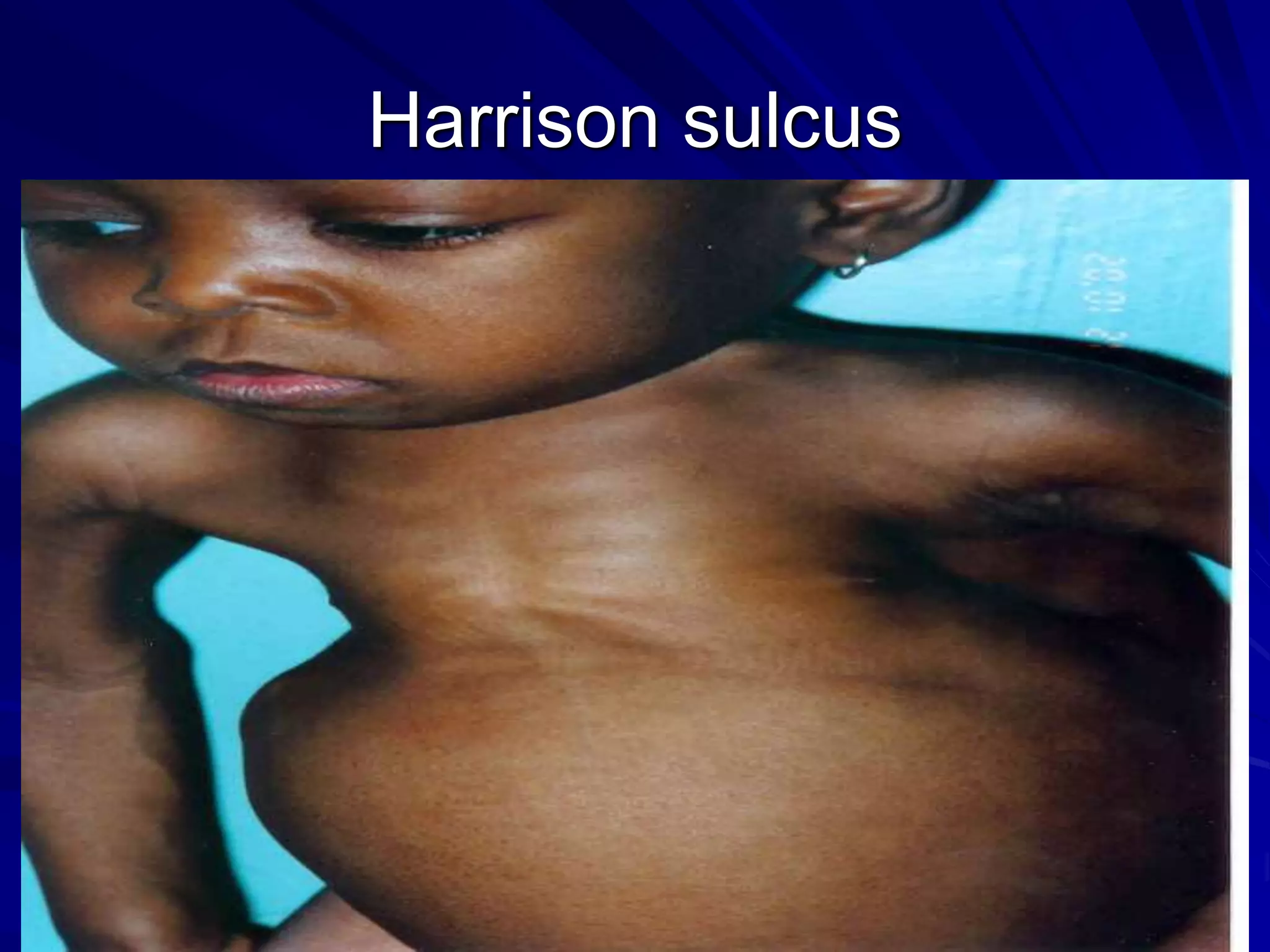 Rickets and osteomalacia | PPT