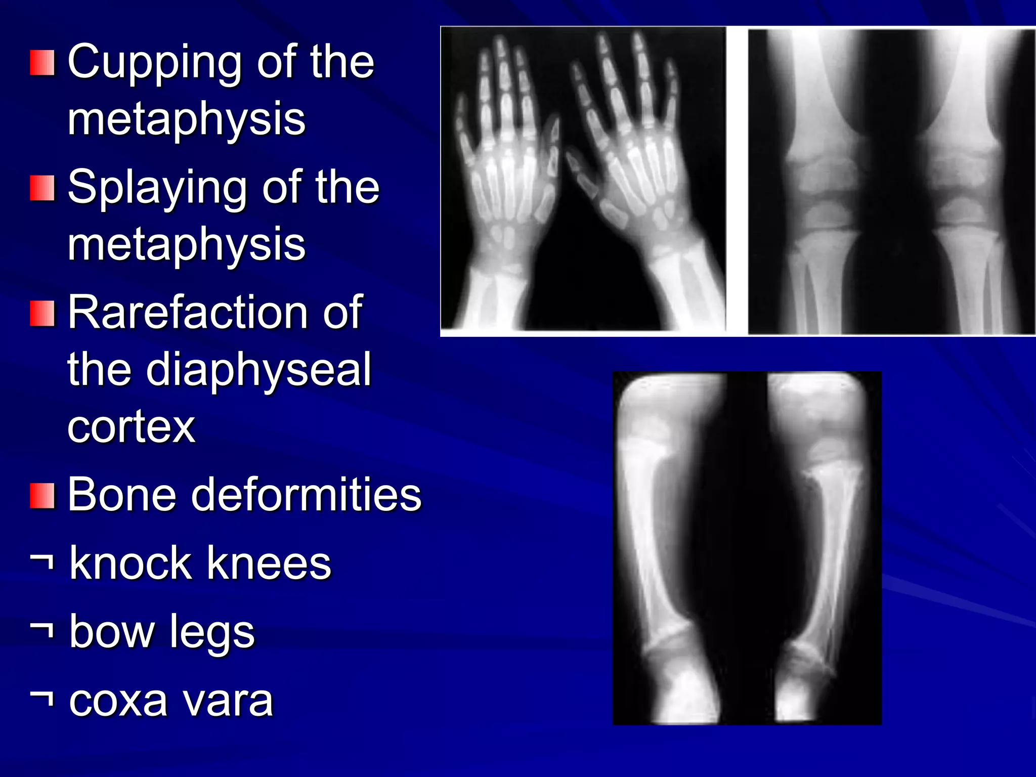Rickets and osteomalacia | PPT