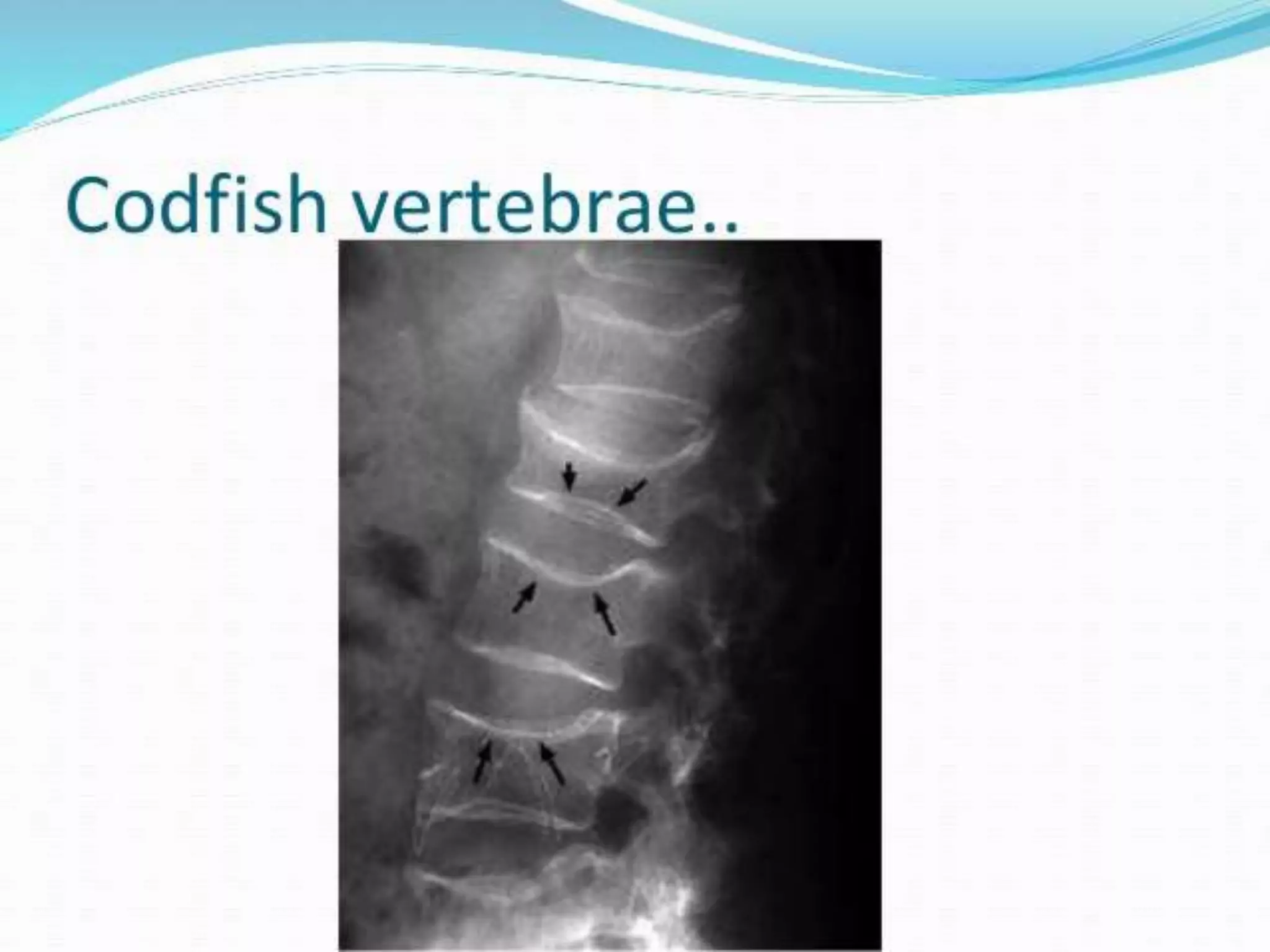Rickets and osteomalacia | PPT