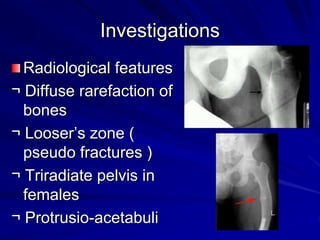 Triradiate Pelvis Osteomalacia