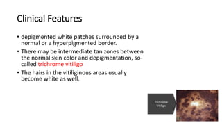 7.vitiligo , melasma | PPTX
