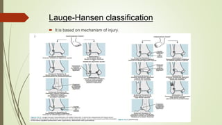 Ankle fractures | PPTX
