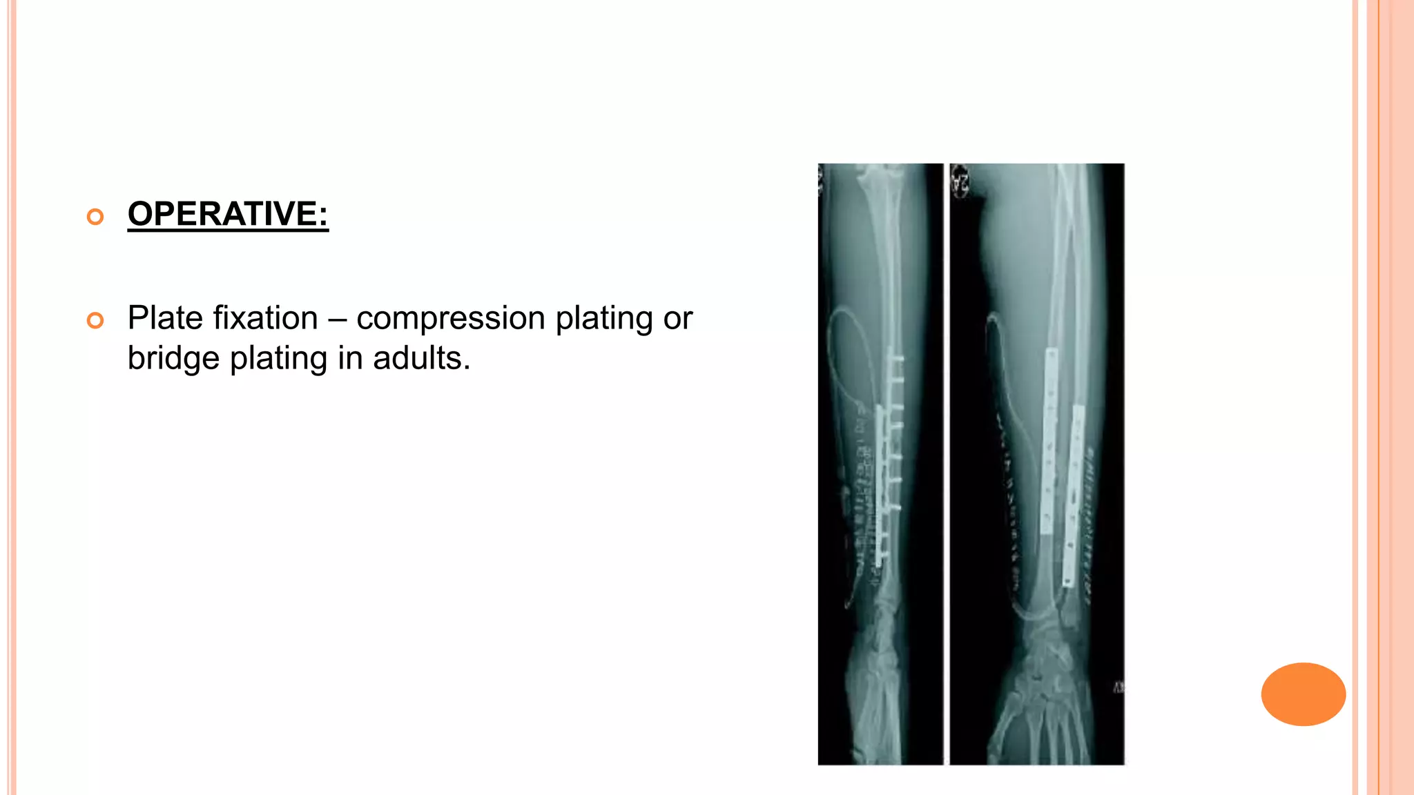 Forearm fractures | PPTX