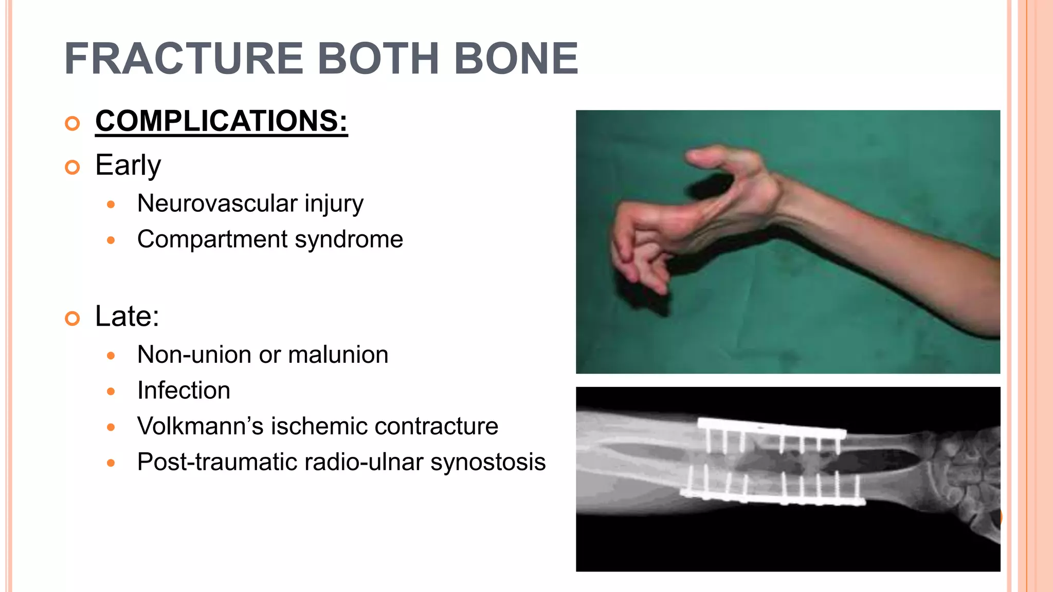 Forearm fractures | PPTX