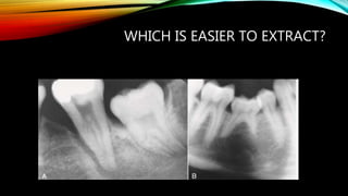 Routine Exodontia | PPTX