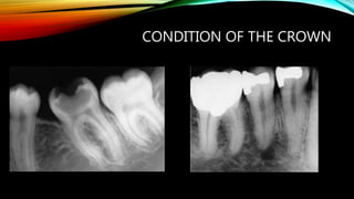 Routine Exodontia | PPTX