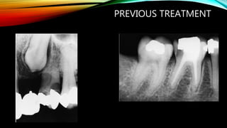 Routine Exodontia | PPTX