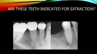 Routine Exodontia | PPTX