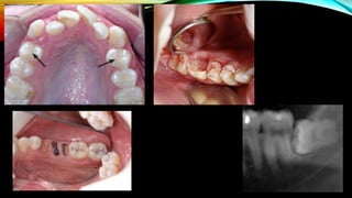 Routine Exodontia | PPTX