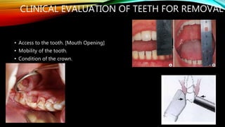 Routine Exodontia | PPTX