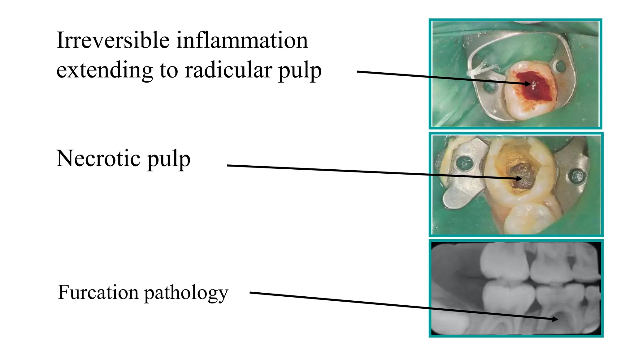 7. non vital pulp therapy | PPTX