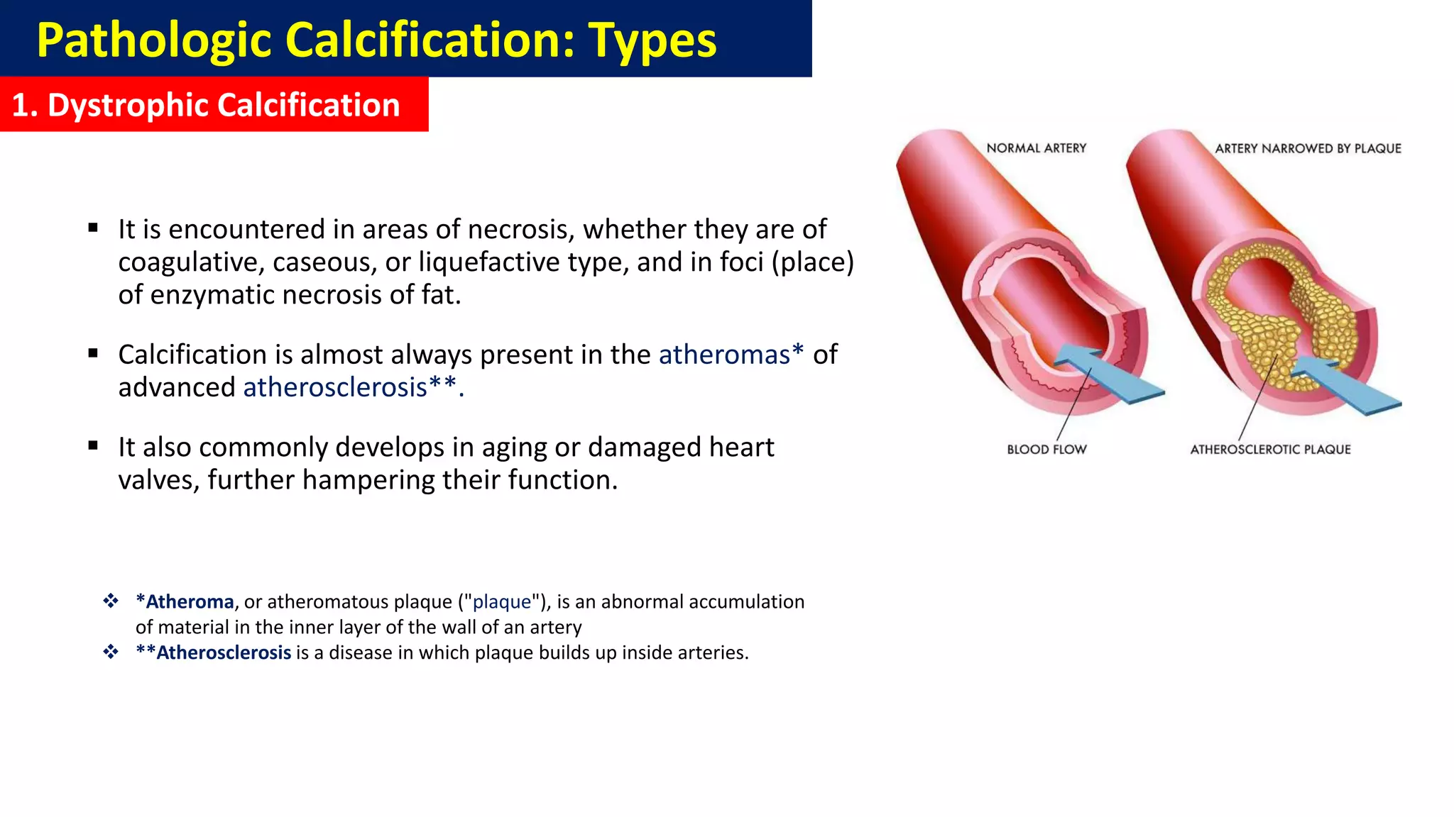Calcification by Rohit Kumar Trivedi | PPT Calcification by Rohit Kumar Trivedi | PPT