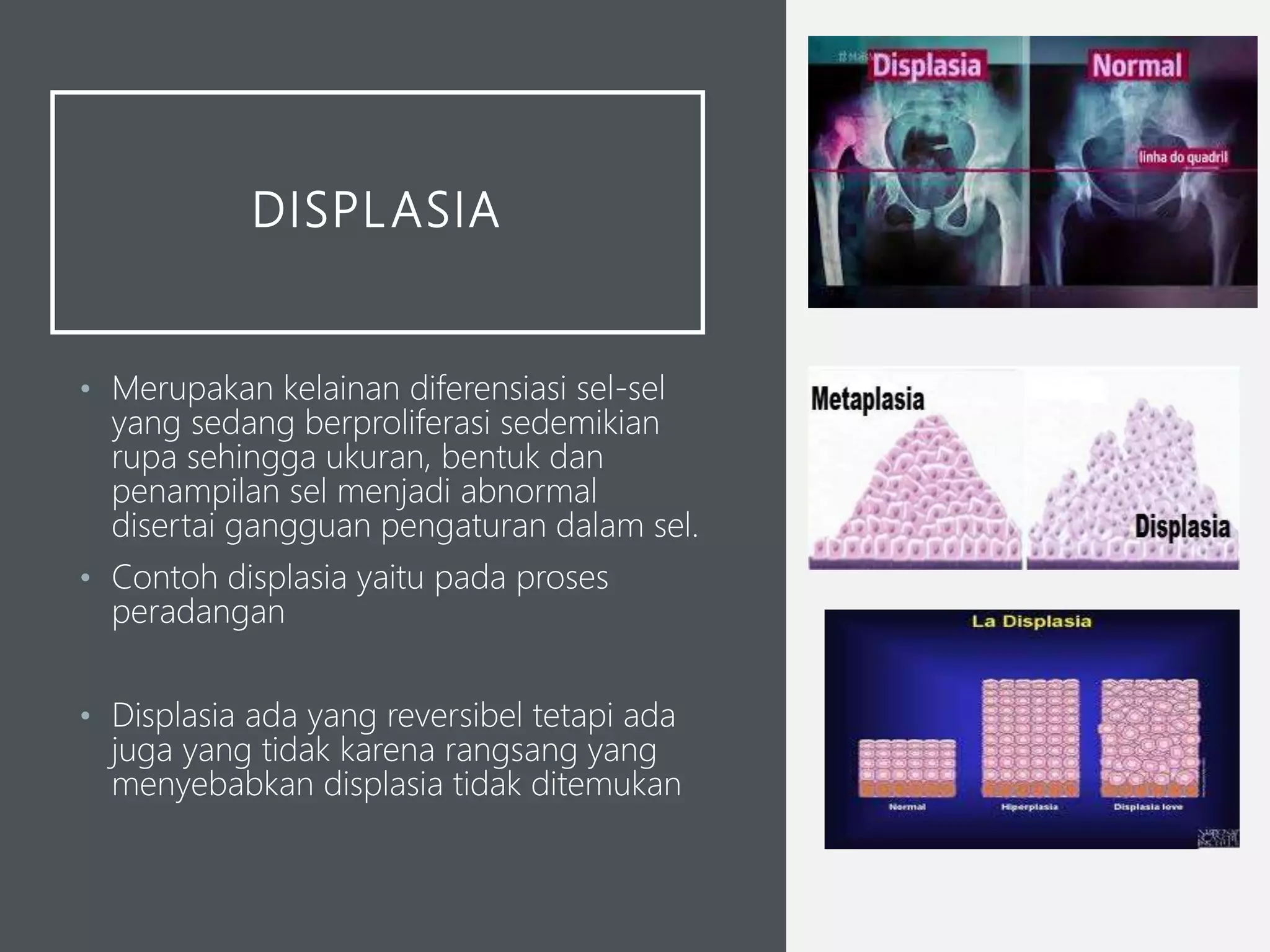 7. penyakit neoplasia | PPTX