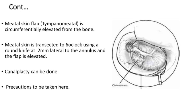 7. TYMPAMOPLASTY, OCR, STAPEDOTOMY PRESENTATION.pptx | Ear, Nose and ...