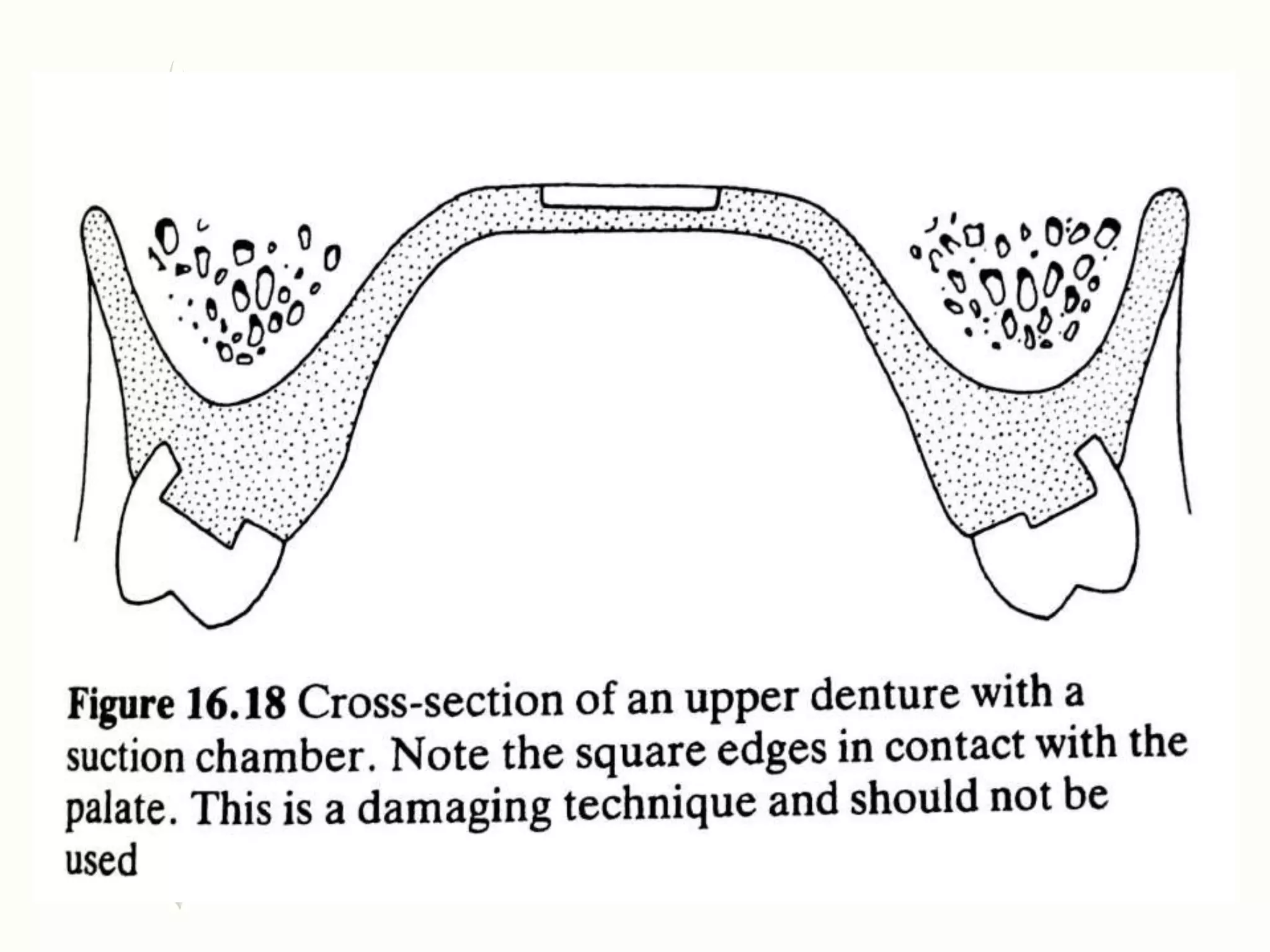 7. RETENTION IN COMPLETE DENTURE.pptx