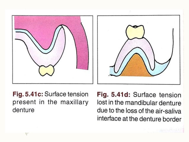 7. RETENTION IN COMPLETE DENTURE.pptx