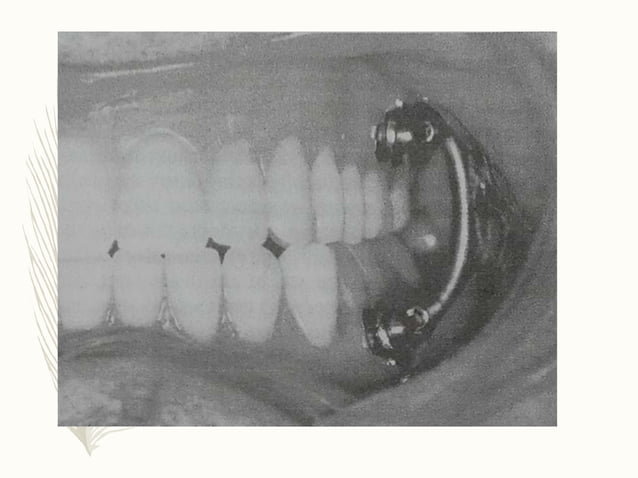 7. RETENTION IN COMPLETE DENTURE.pptx