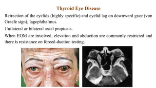 7. ocular, Systemic disease.pptx