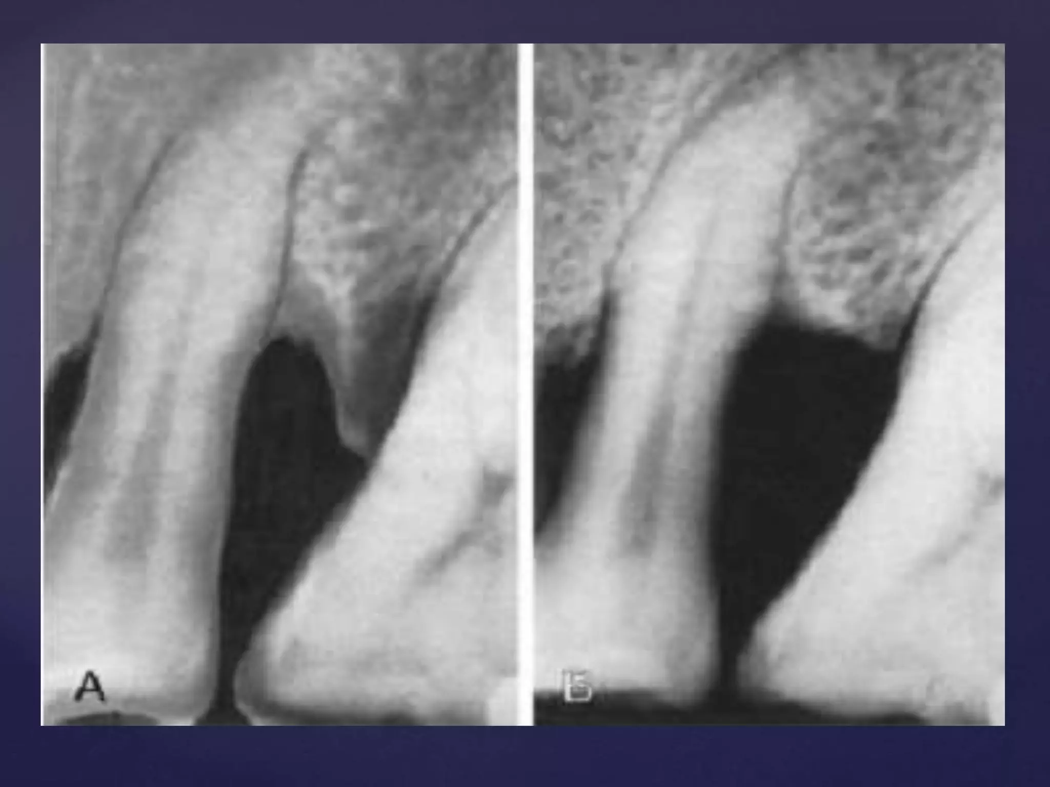 7. Remodeling Resective Osseous Surgery.pptx