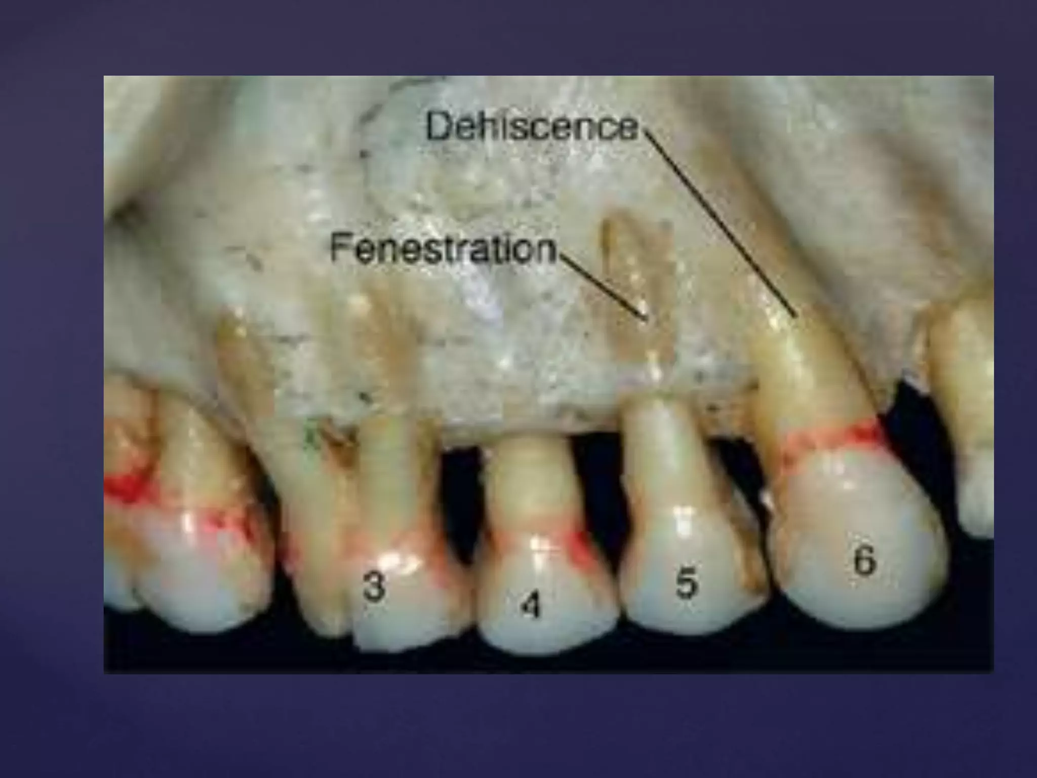 7. Remodeling Resective Osseous Surgery.pptx