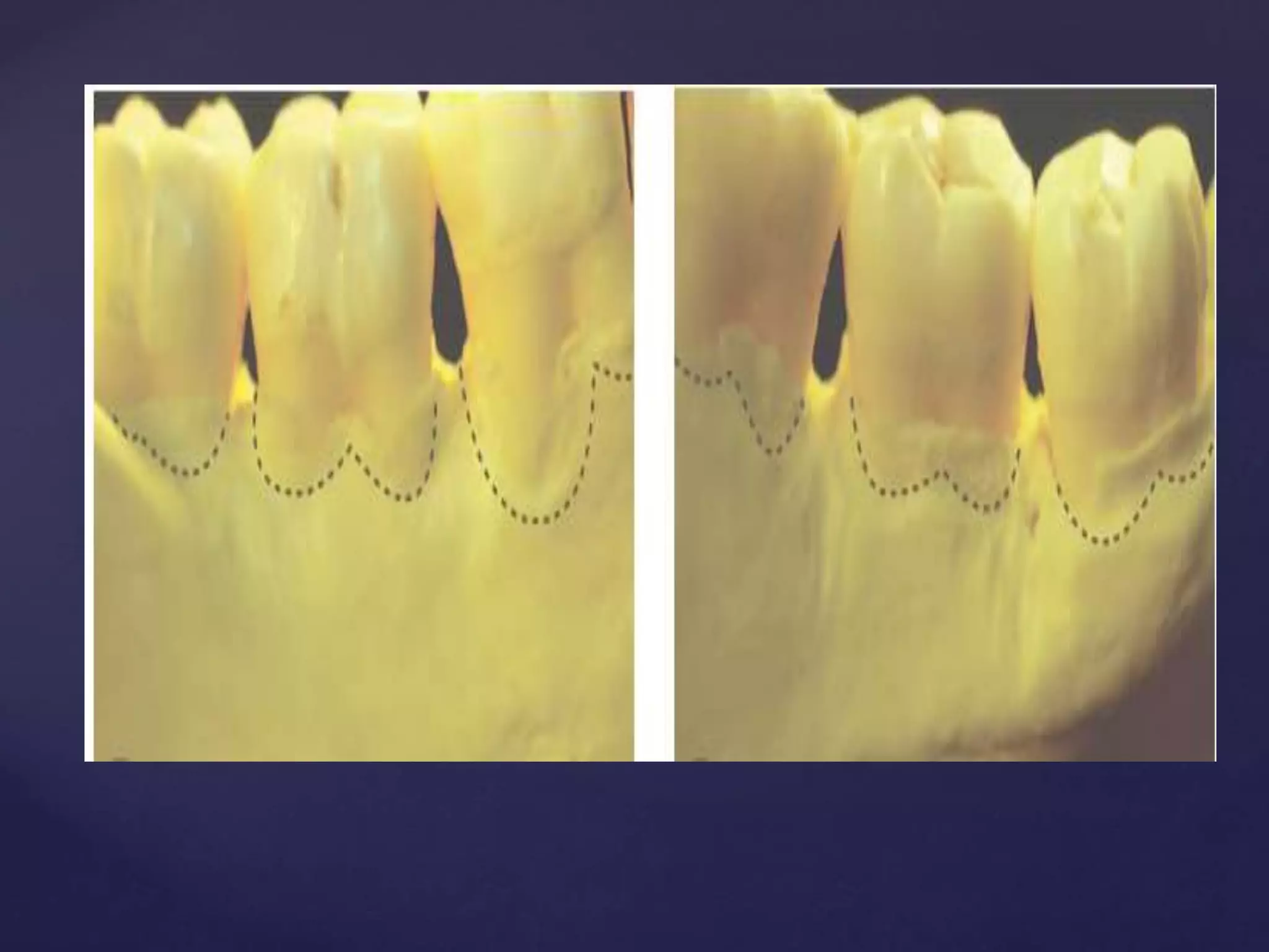 7. Remodeling Resective Osseous Surgery.pptx