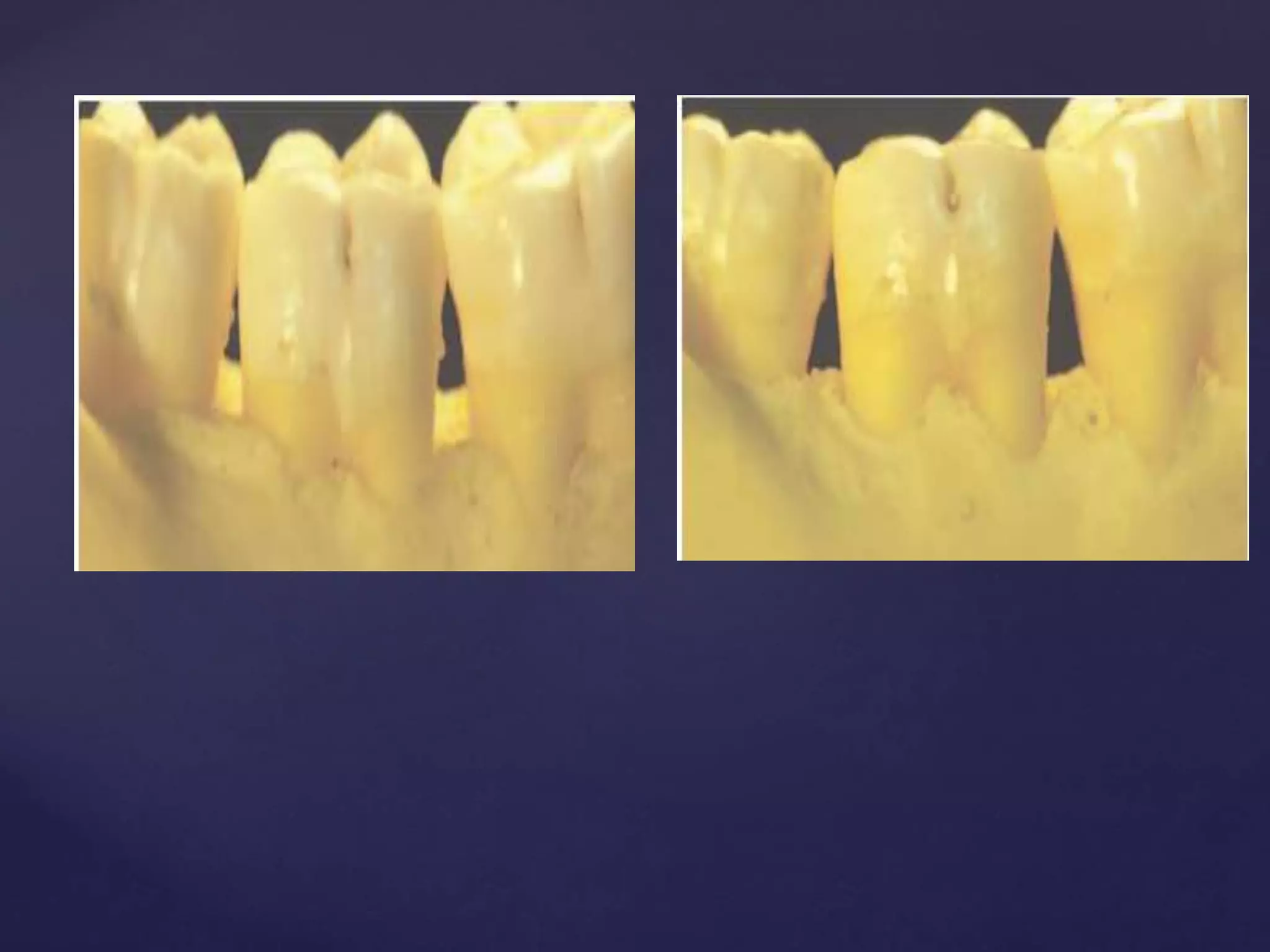7. Remodeling Resective Osseous Surgery.pptx
