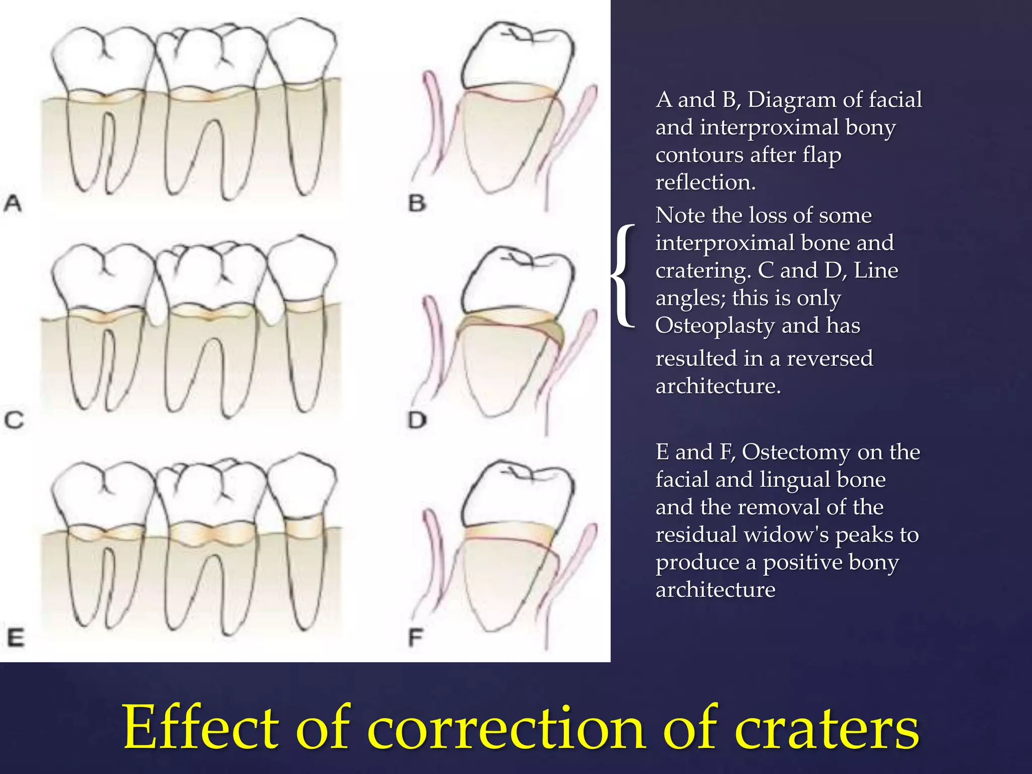 7. Remodeling Resective Osseous Surgery.pptx