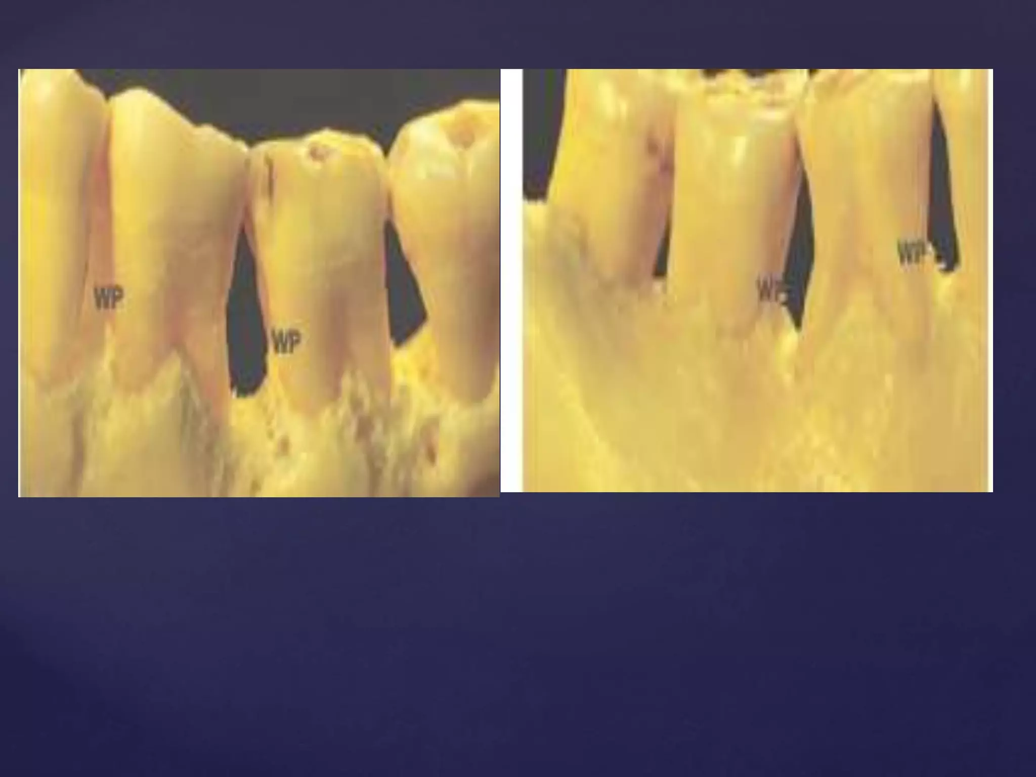 7. Remodeling Resective Osseous Surgery.pptx