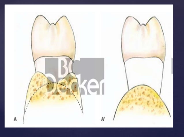 7. Remodeling Resective Osseous Surgery.pptx