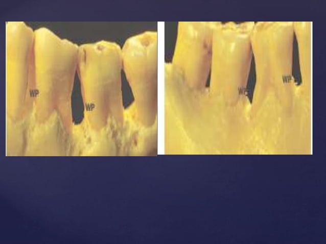 7. Remodeling Resective Osseous Surgery.pptx