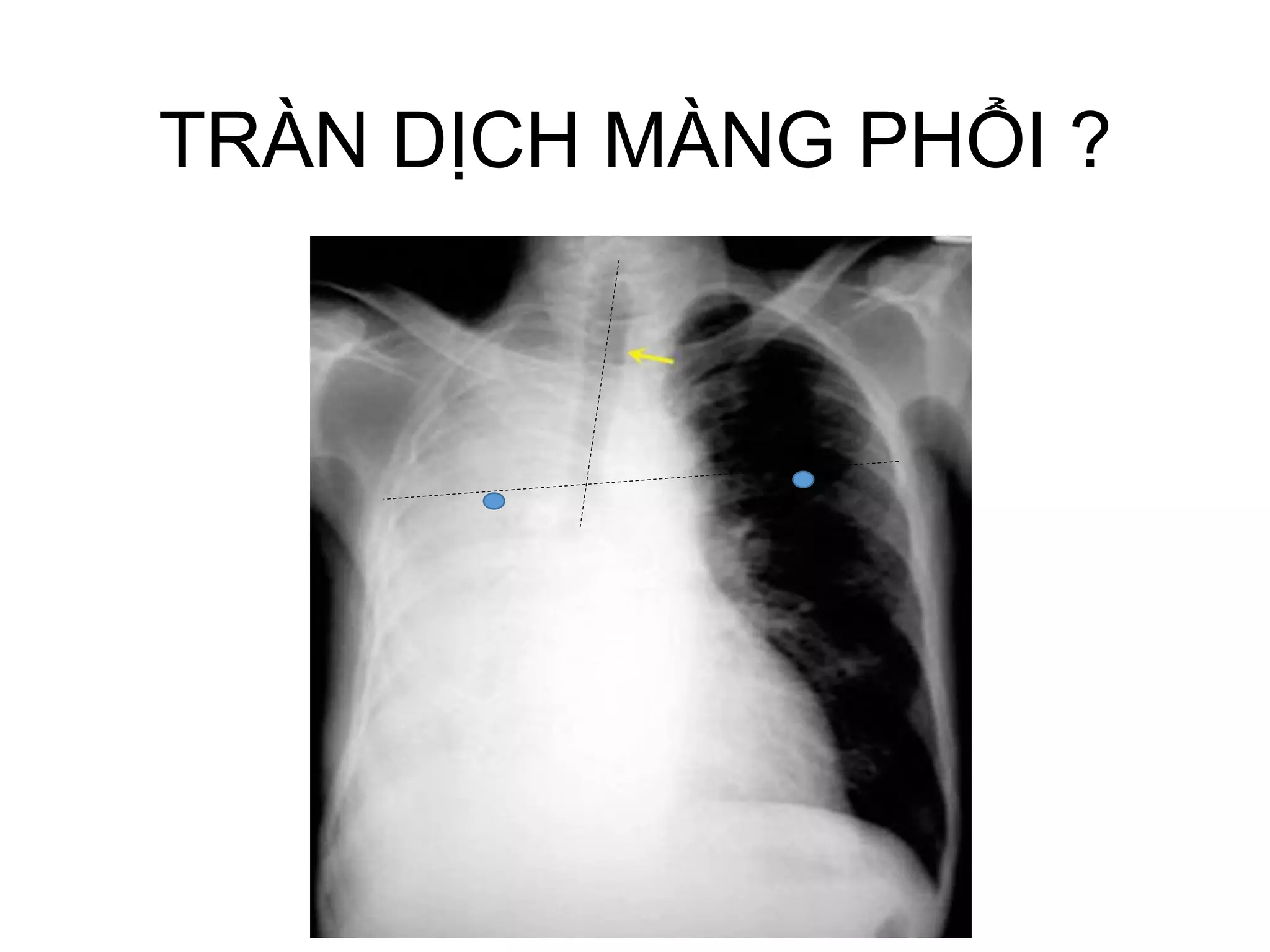 Xquang ngực cơ bản | PDF